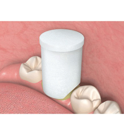 Premier Retraction Caps #1 120/Pk – Curio.Dental